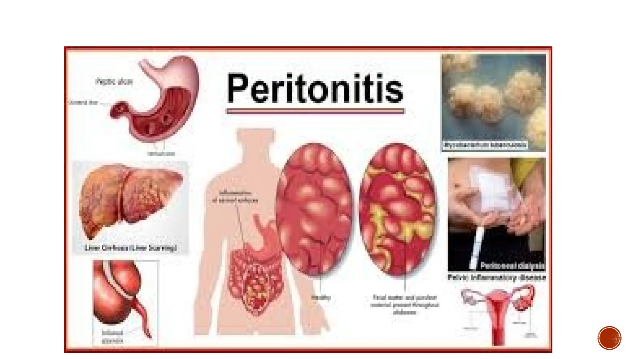 Peritonitis.pptxeru64336888533578hffjit66787 | PPT