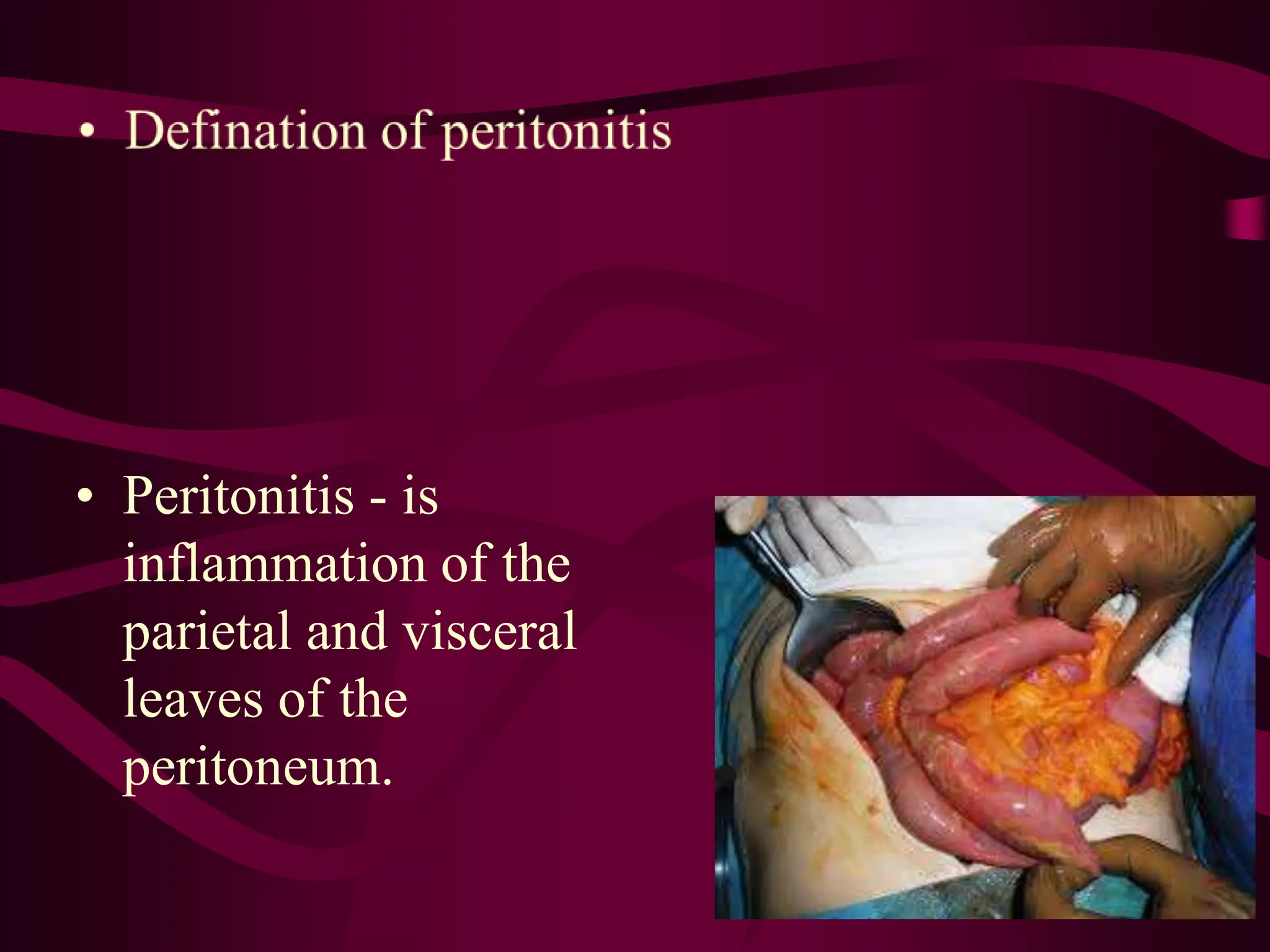 Peritonitis (1).ppt or inflammation of peritoneum | PPT
