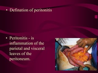 Peritonitis (1).ppt or inflammation of peritoneum | PPT