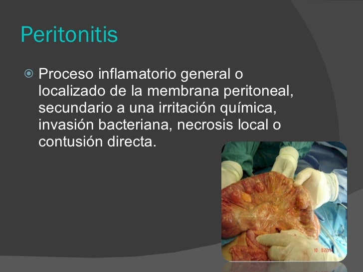 Peritonitis 2