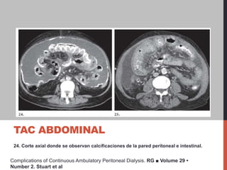 Peritonitis esclerosante | PPTX