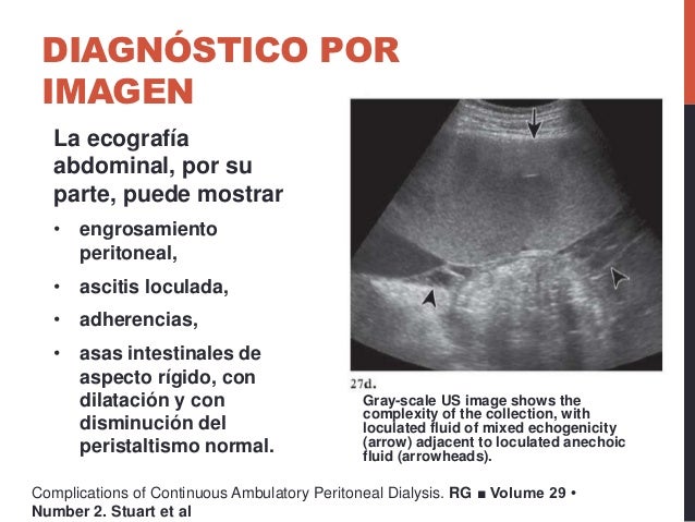 Peritonitis esclerosante