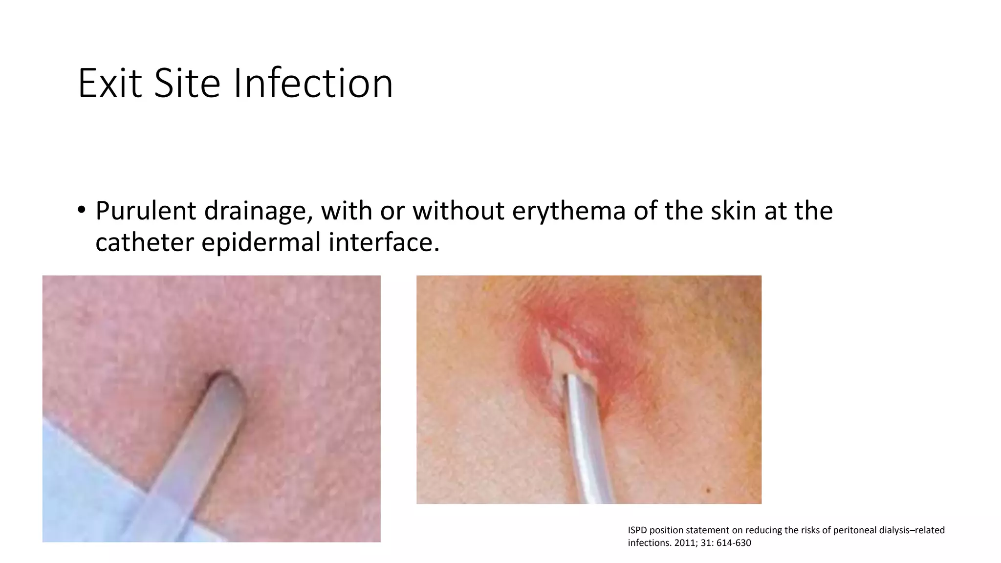 Peritonitis, exit site care, catheter related infection | PPTX