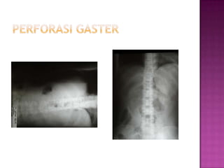 Peritonitis generalisata | PPT