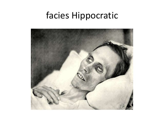 Peritonitis Rochi sfuchas