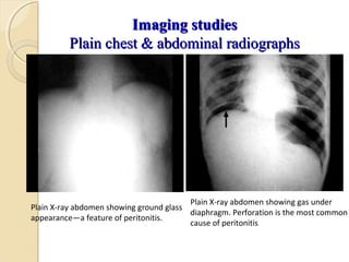 Peritonitis kawiz | PPT