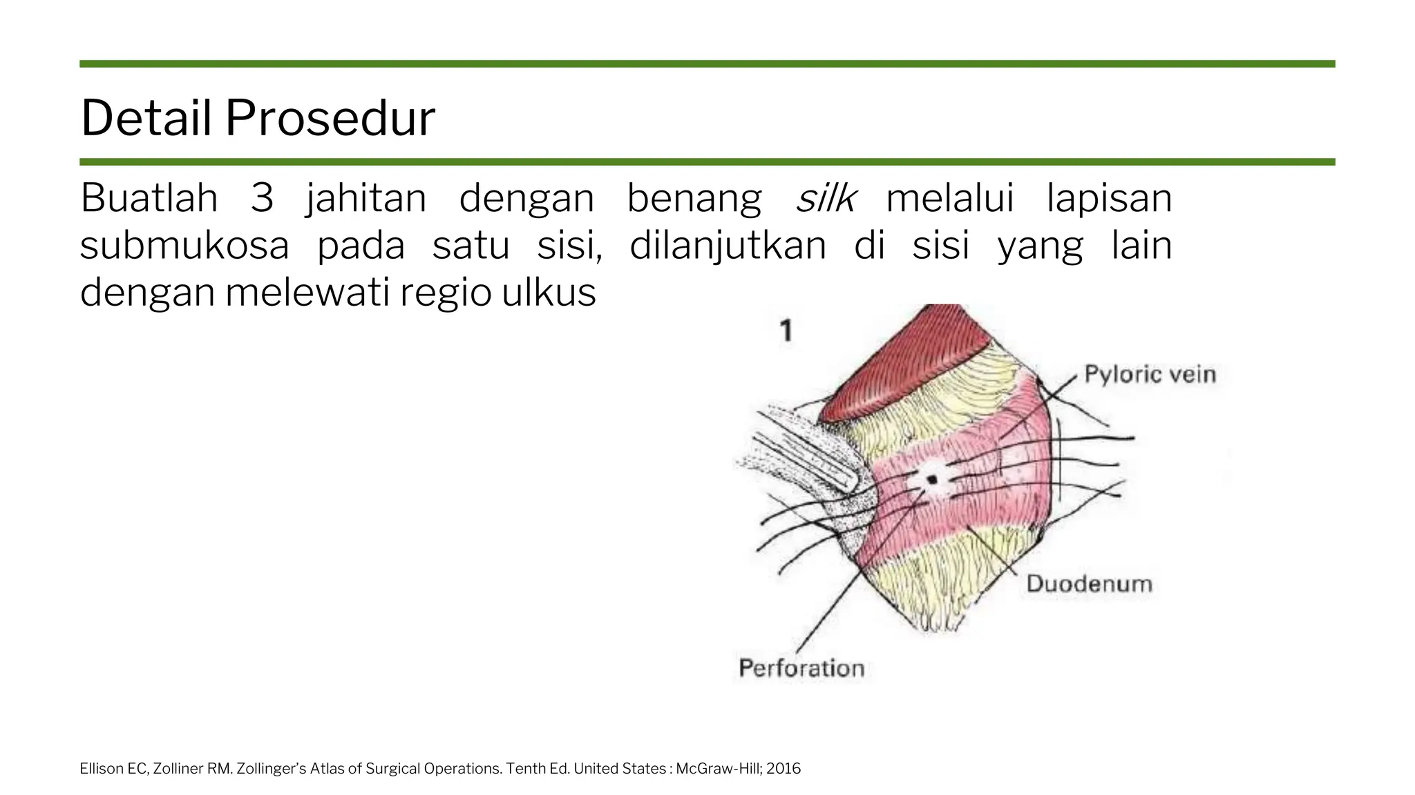 Peritonitis dan Optek Perforasi Gaster.pptx