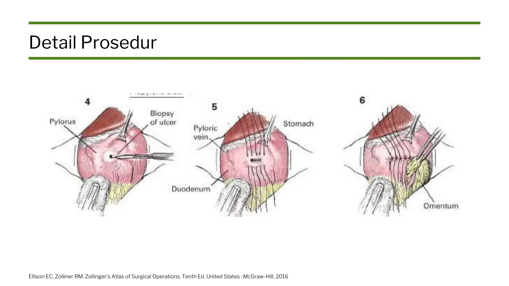 Peritonitis dan Optek Perforasi Gaster.pptx