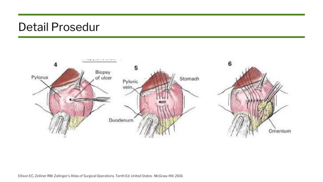 Peritonitis dan Optek Perforasi Gaster.pptx
