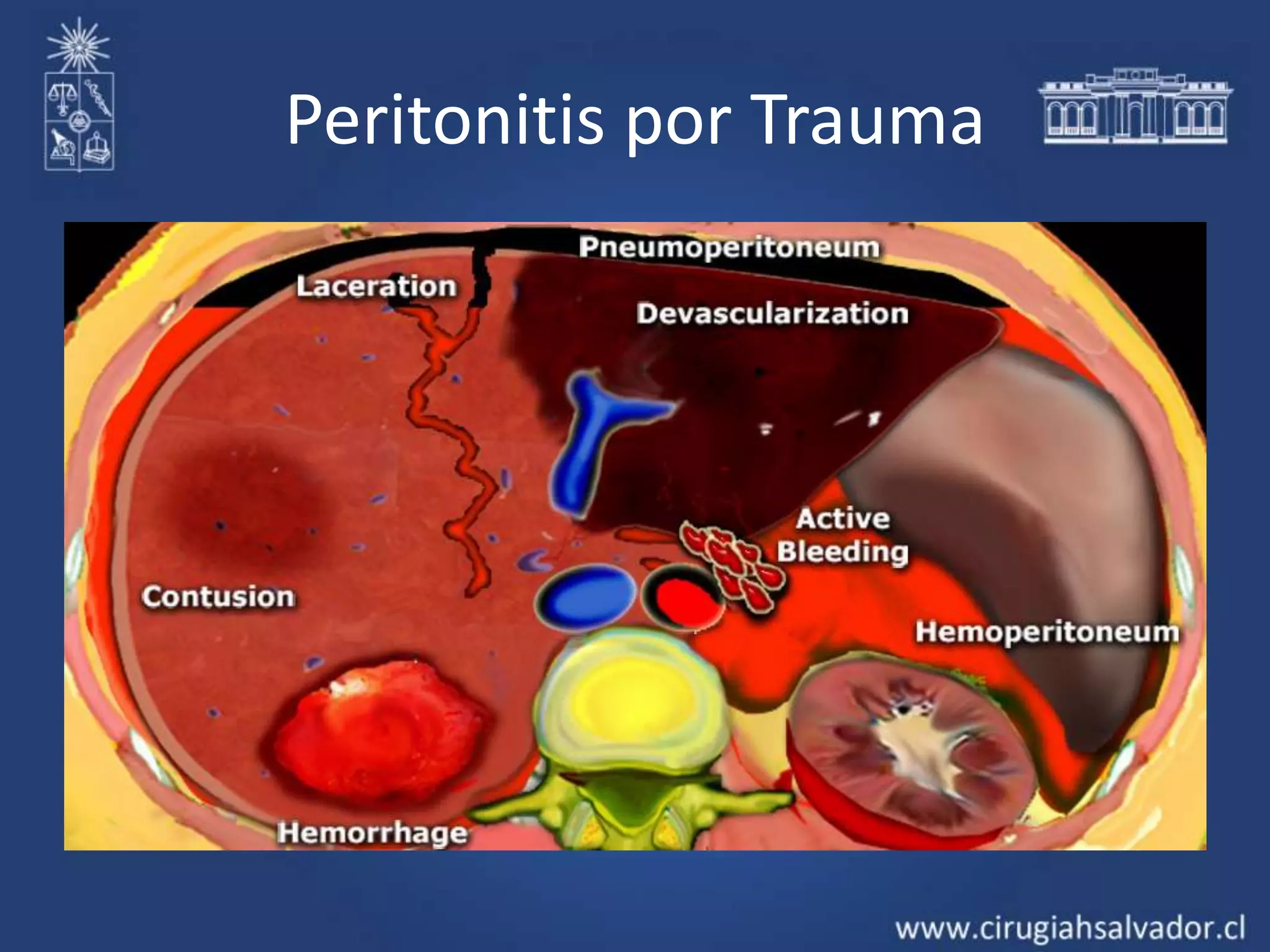 Peritonitis ppt