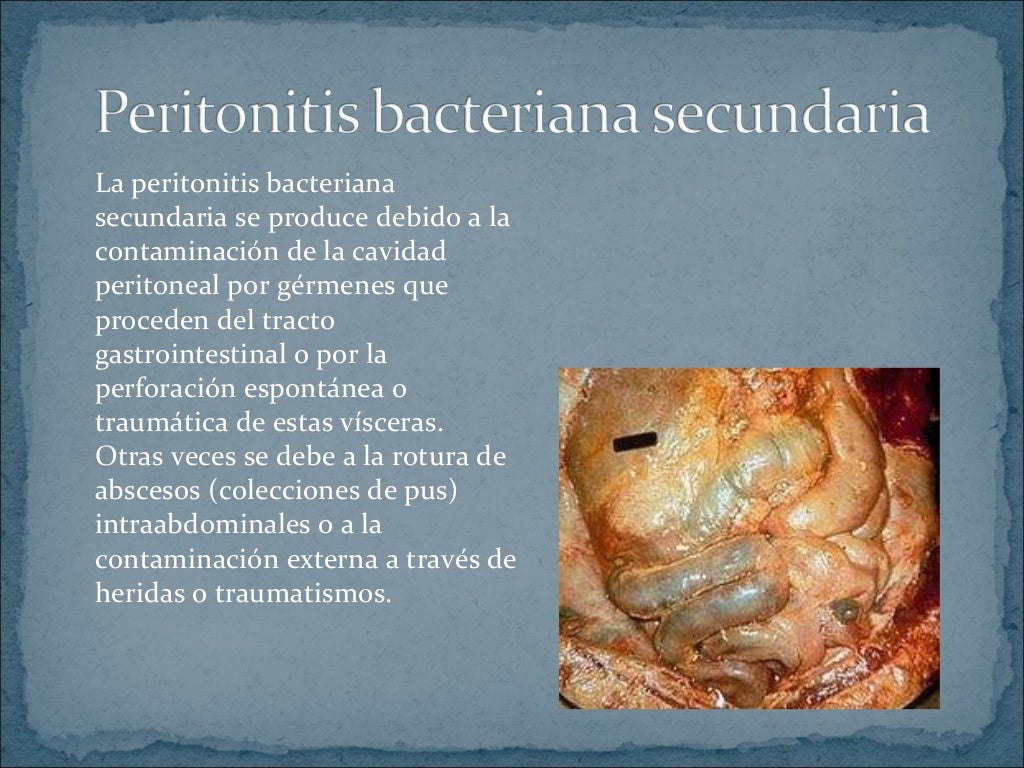 PERITONITIS