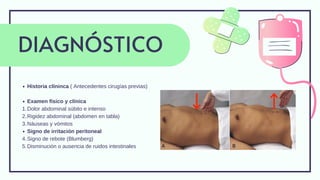 Peritonitis séptica, química y granulomatosa.pdf