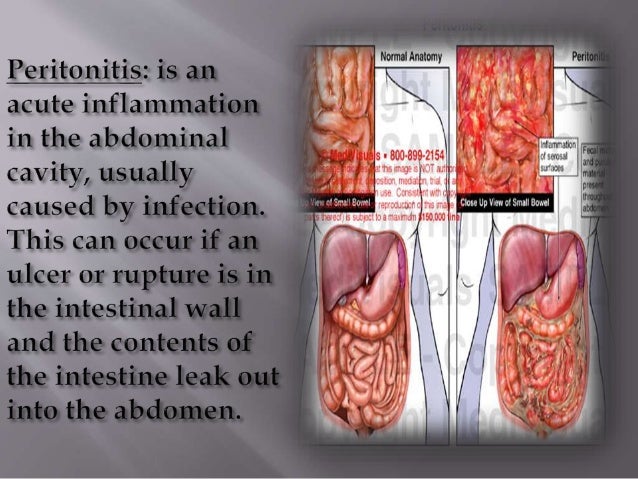Peritonium (anatomy and physiology and pathology)