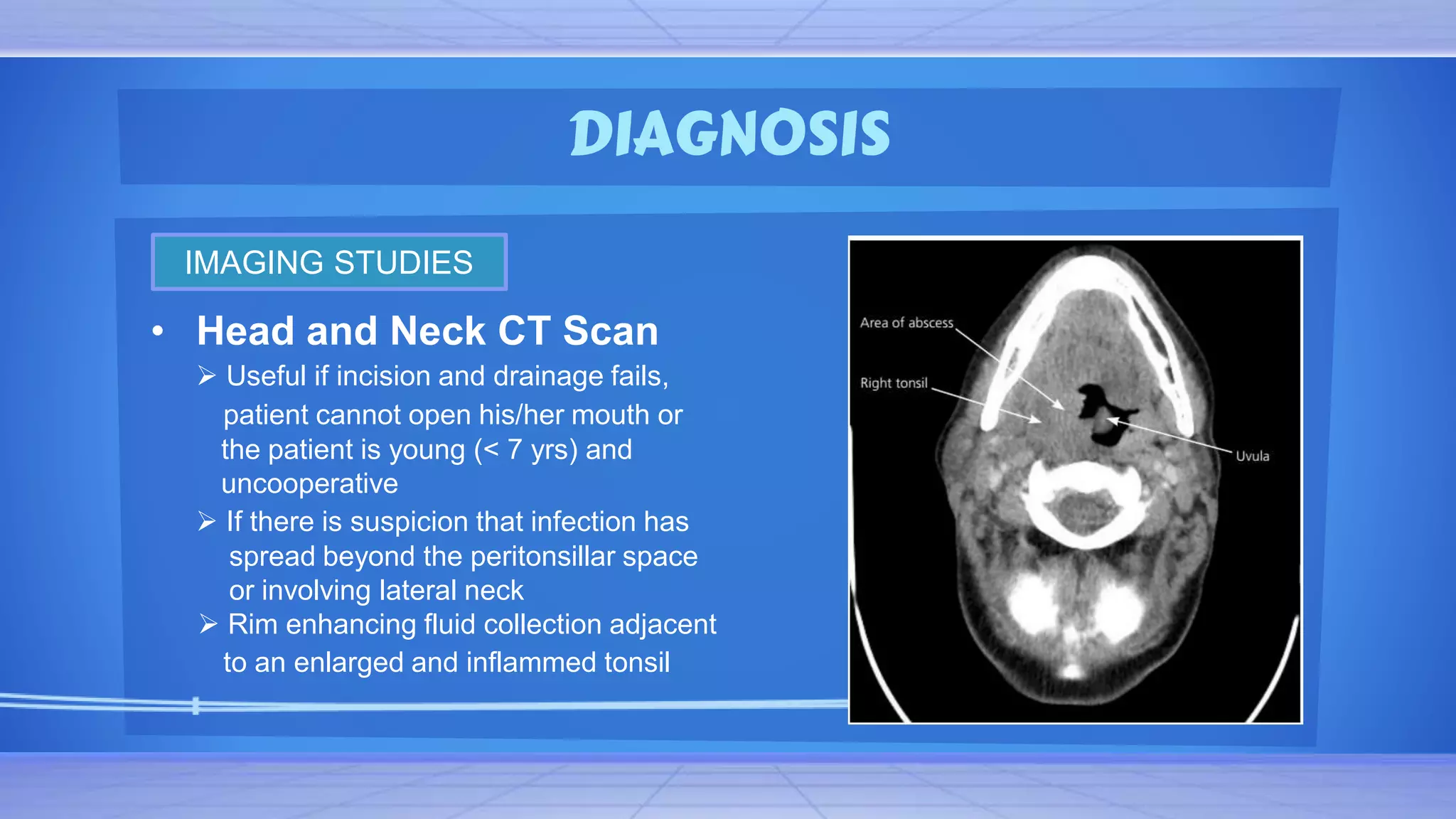 Peritonsillar Abscess (Quinsy) | PPT