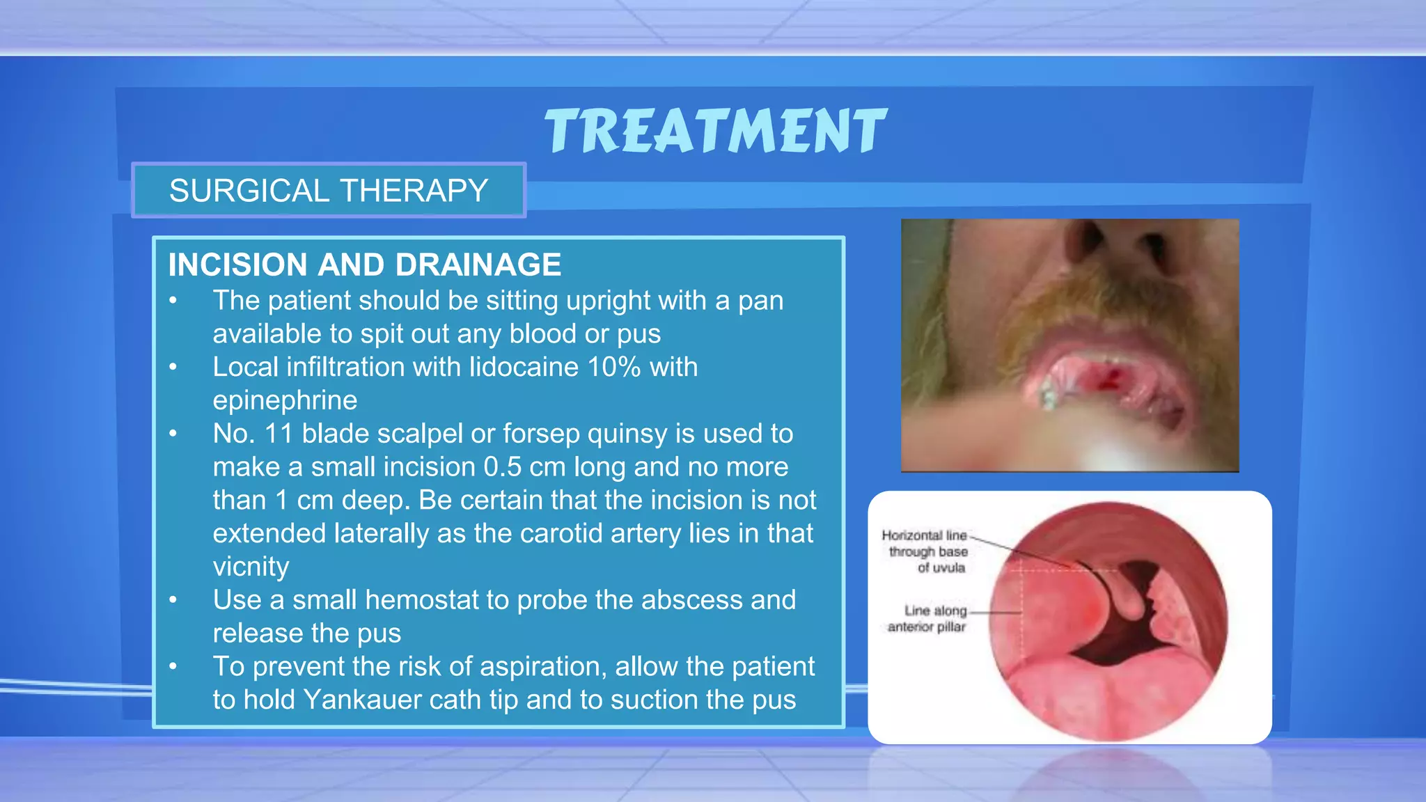 Peritonsillar Abscess (Quinsy) | PPT