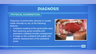 Peritonsillar Abscess (Quinsy) | PPT