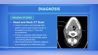 Peritonsillar Abscess (Quinsy) | PPT