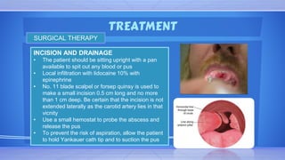 Peritonsillar Abscess (Quinsy) | PPTX