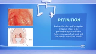 Peritonsillar Abscess (Quinsy) | PPT