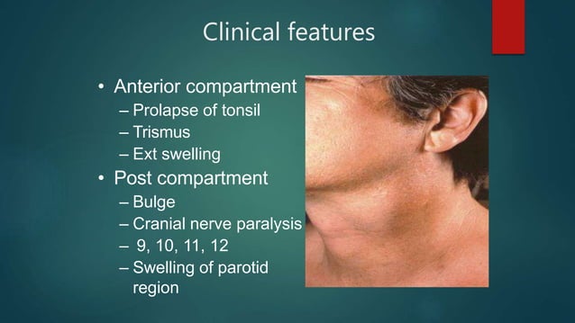 Peritonsillar abscess, parapharyngeal abscess, retropharyngeal abscess ...