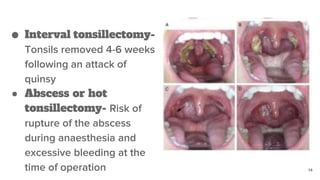 Peritonsillar abscess (quinsy) | PPTX