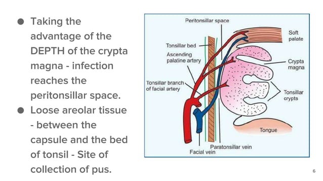 Peritonsillar abscess (quinsy) | PPTX | Ear, Nose and Throat Conditions ...