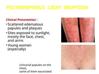 Perivascular dermatitis in human skin.pptx