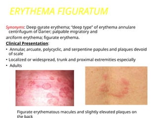 Perivascular dermatitis in human skin.pptx