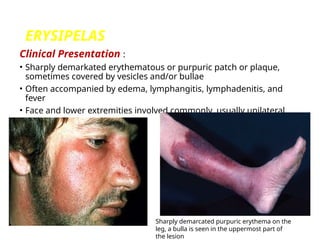 Perivascular dermatitis in human skin.pptx