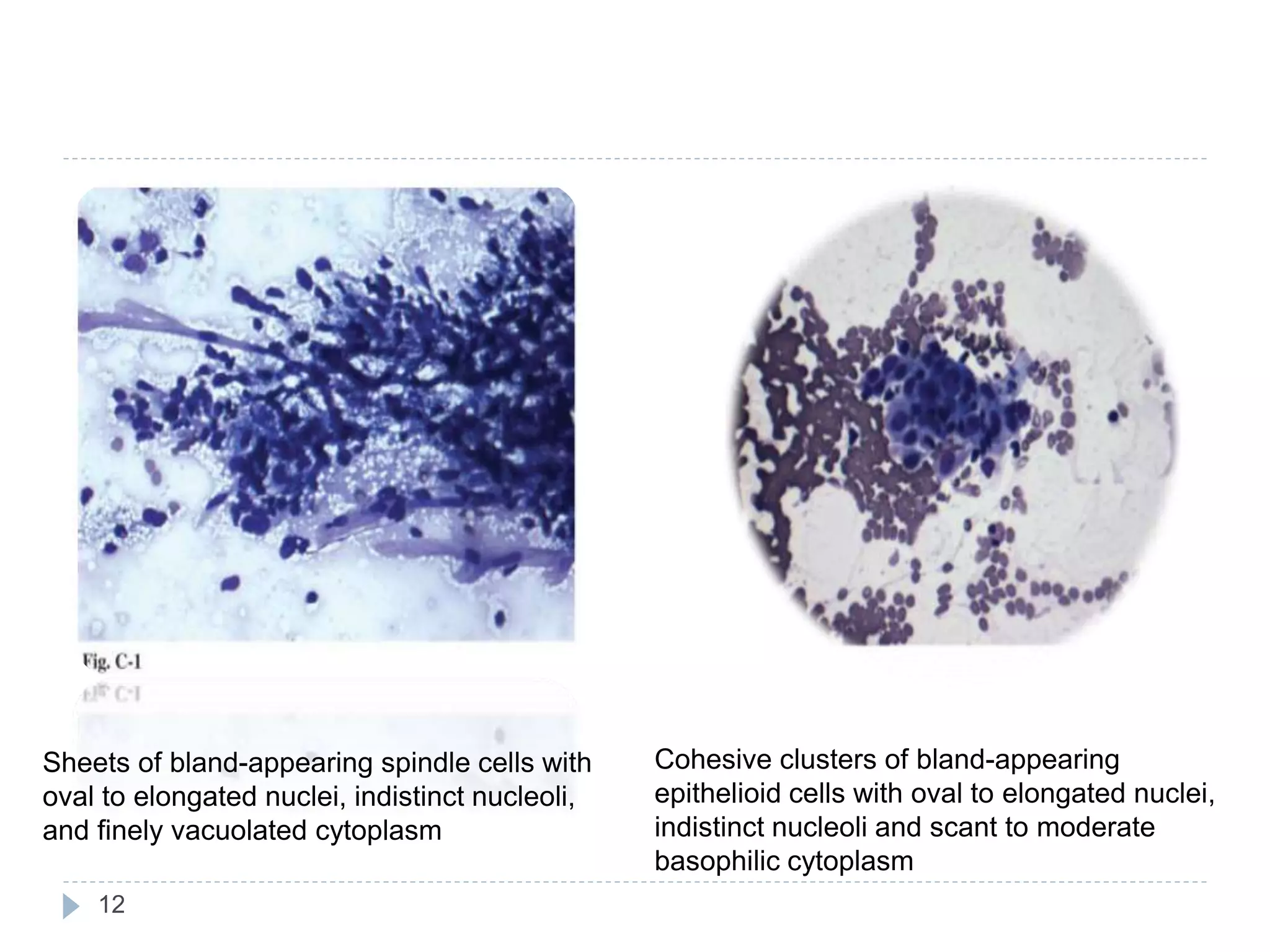 Perivascular epithelioid cell neoplasm (PEComas) | PPTX | Genetics ...