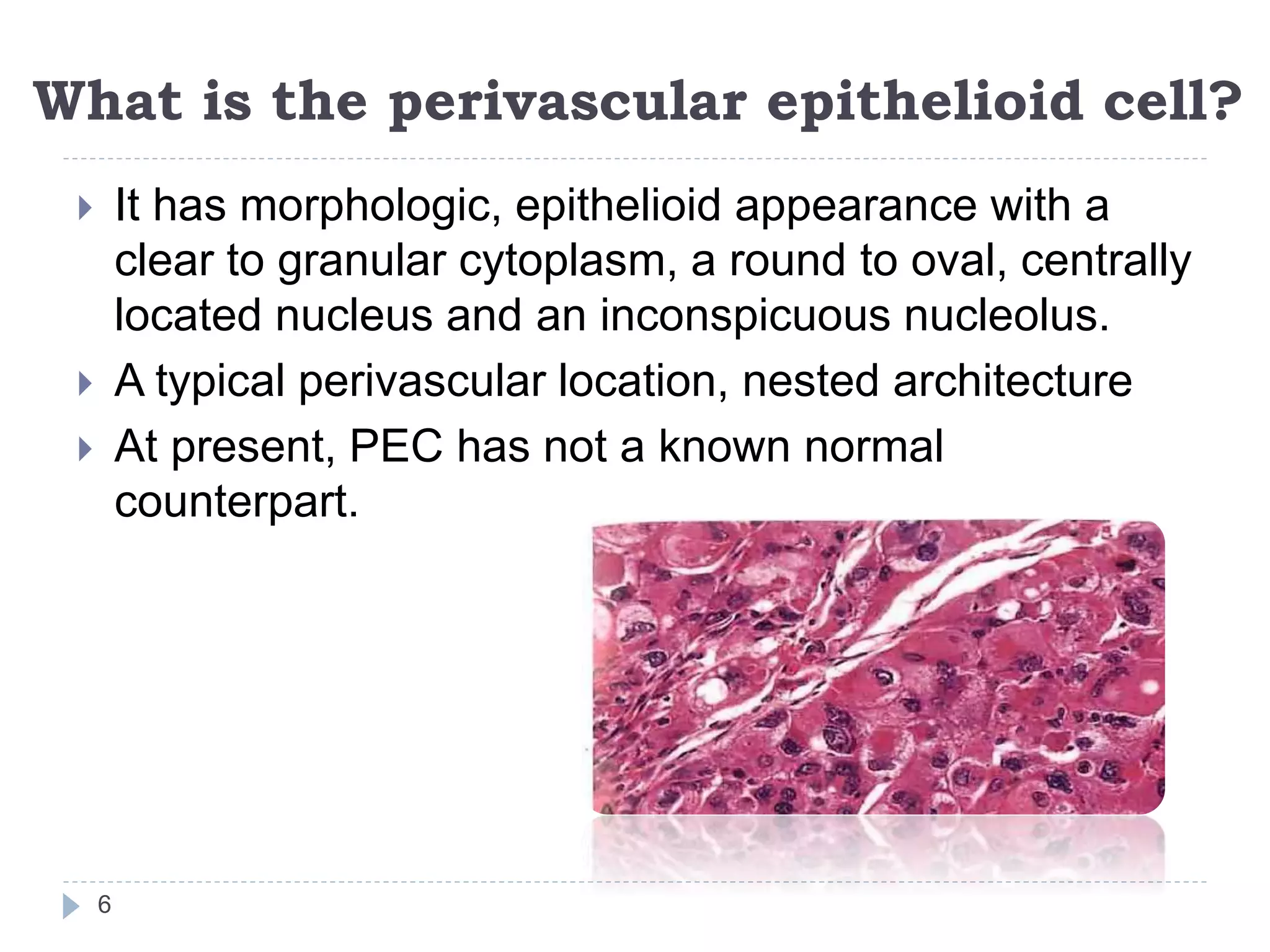 Perivascular epithelioid cell neoplasm (PEComas) | PPTX | Genetics ...