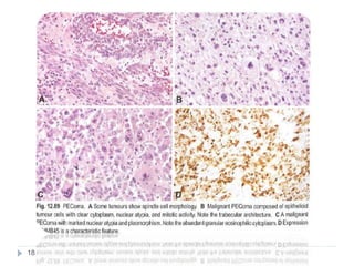 Perivascular epithelioid cell neoplasm (PEComas) | PPTX