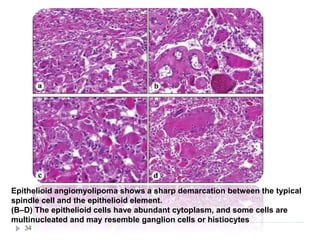 Perivascular epithelioid cell neoplasm (PEComas) | PPTX