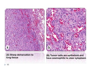 Perivascular epithelioid cell neoplasm (PEComas) | PPTX