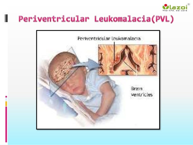 What Causes Pvl In Children | Epilepsy in Children: Causes, Symptoms ...