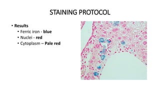 perls prusian blue stain in hematology.pptx | Blood Disorders ...