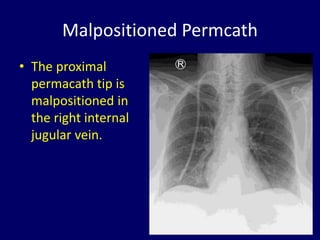 PermacathPlacement under US guaidance DR. muhammad Bin Zulfiqar | PPTX
