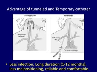PermacathPlacement under US guaidance DR. muhammad Bin Zulfiqar | PPTX