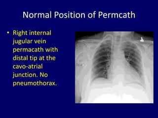 Permacath