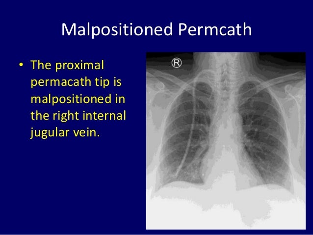 PermacathPlacement under US guaidance DR. muhammad Bin Zulfiqar