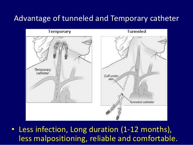 PermacathPlacement under US guaidance DR. muhammad Bin Zulfiqar