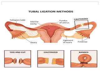 PERMANENT CONTRACEPTION (2).pptx