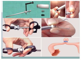 PERMANENT CONTRACEPTION (2).pptx