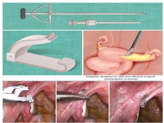 PERMANENT CONTRACEPTION (2).pptx