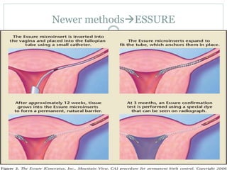 PERMANENT CONTRACEPTION (2).pptx