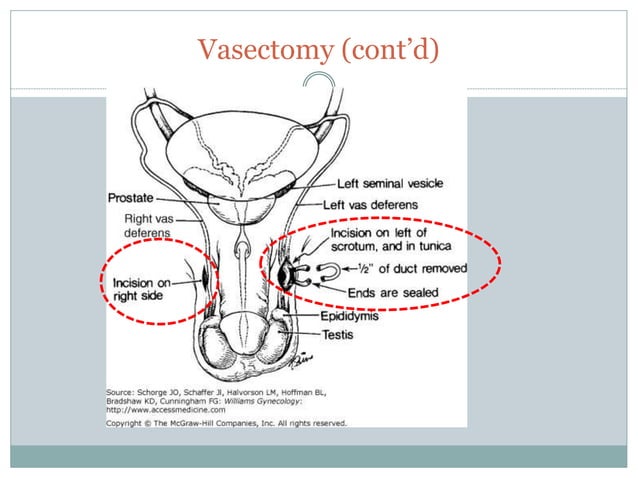 PERMANENT CONTRACEPTION (2).pptx
