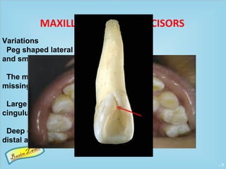 Permanent maxillary lateral incisors | PPT