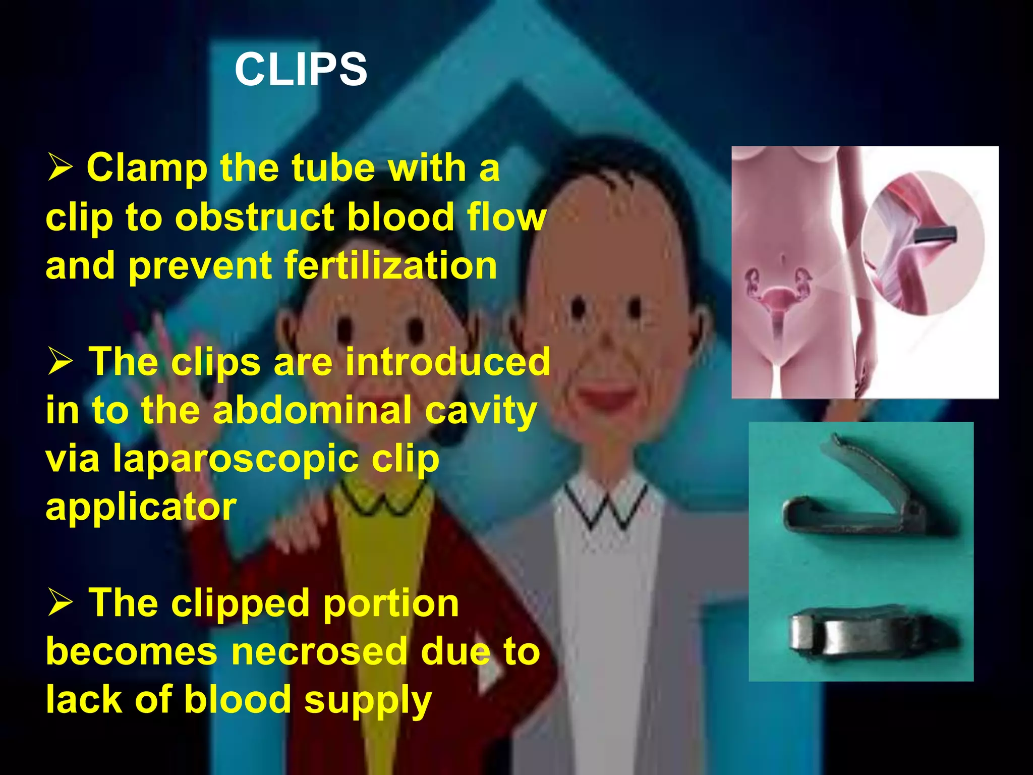 Permanent methods of family planning ppt.-BIJU | PPTX