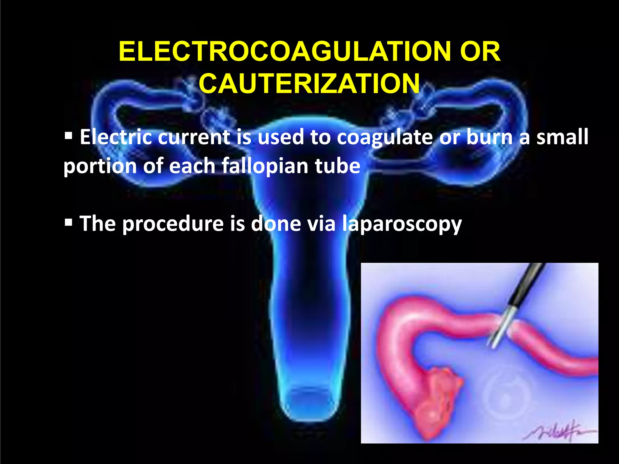 Permanent methods of family planning ppt.-BIJU | PPTX