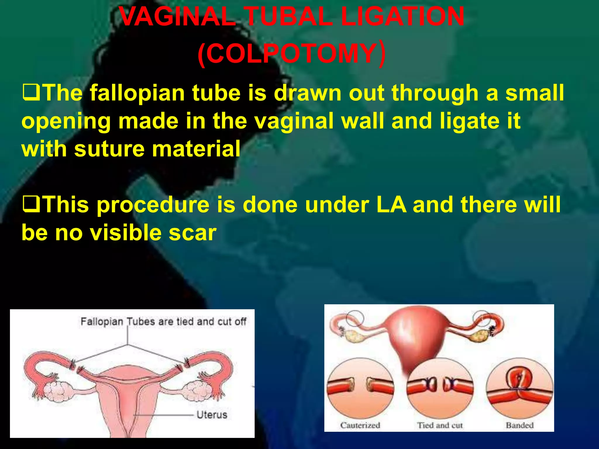 Permanent methods of family planning ppt.-BIJU | PPTX